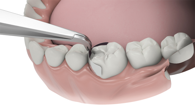 Garrison Dental | Composi-Tight® 3D Fusion™