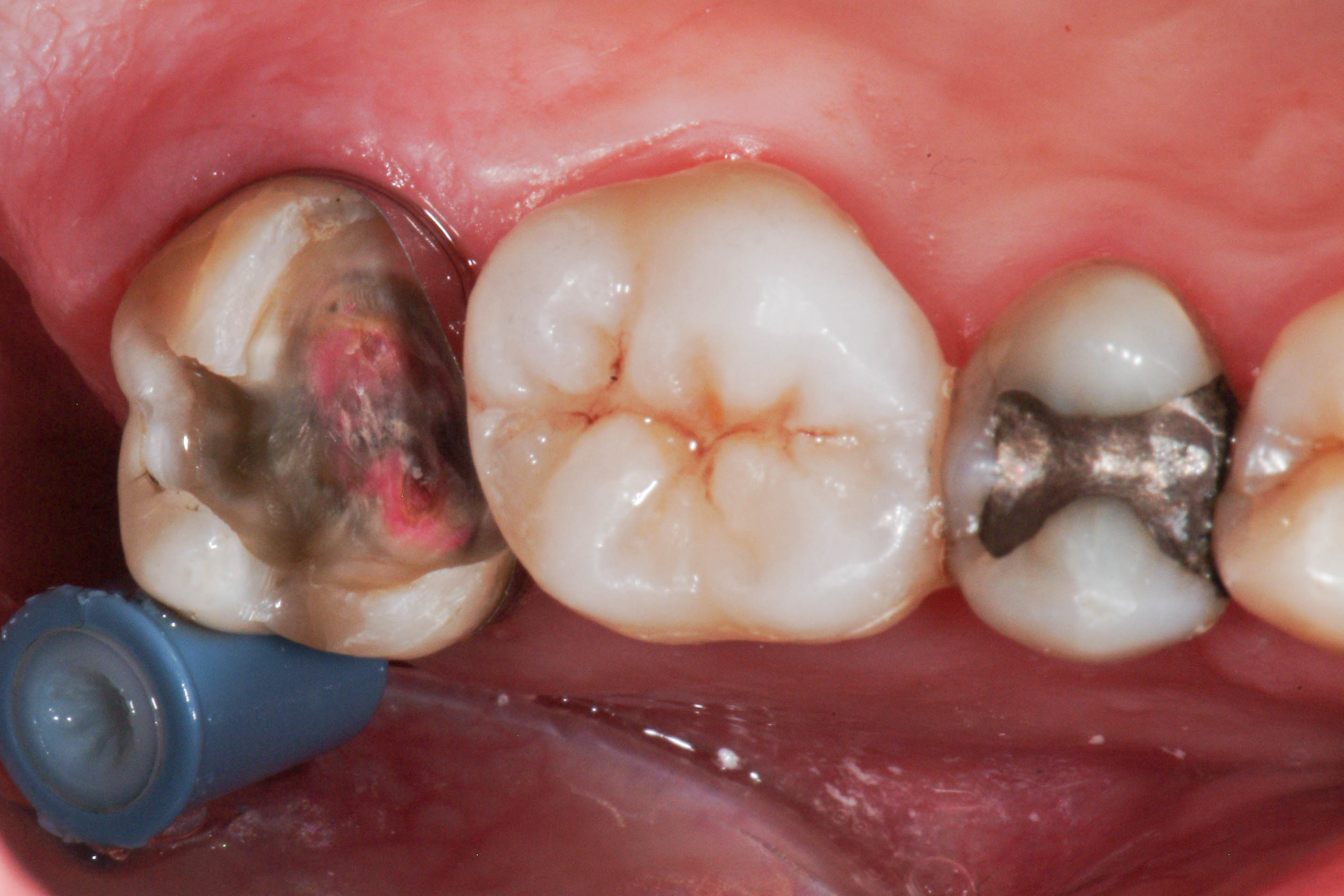 ReelMatrix™ Matrices & Empty Reels