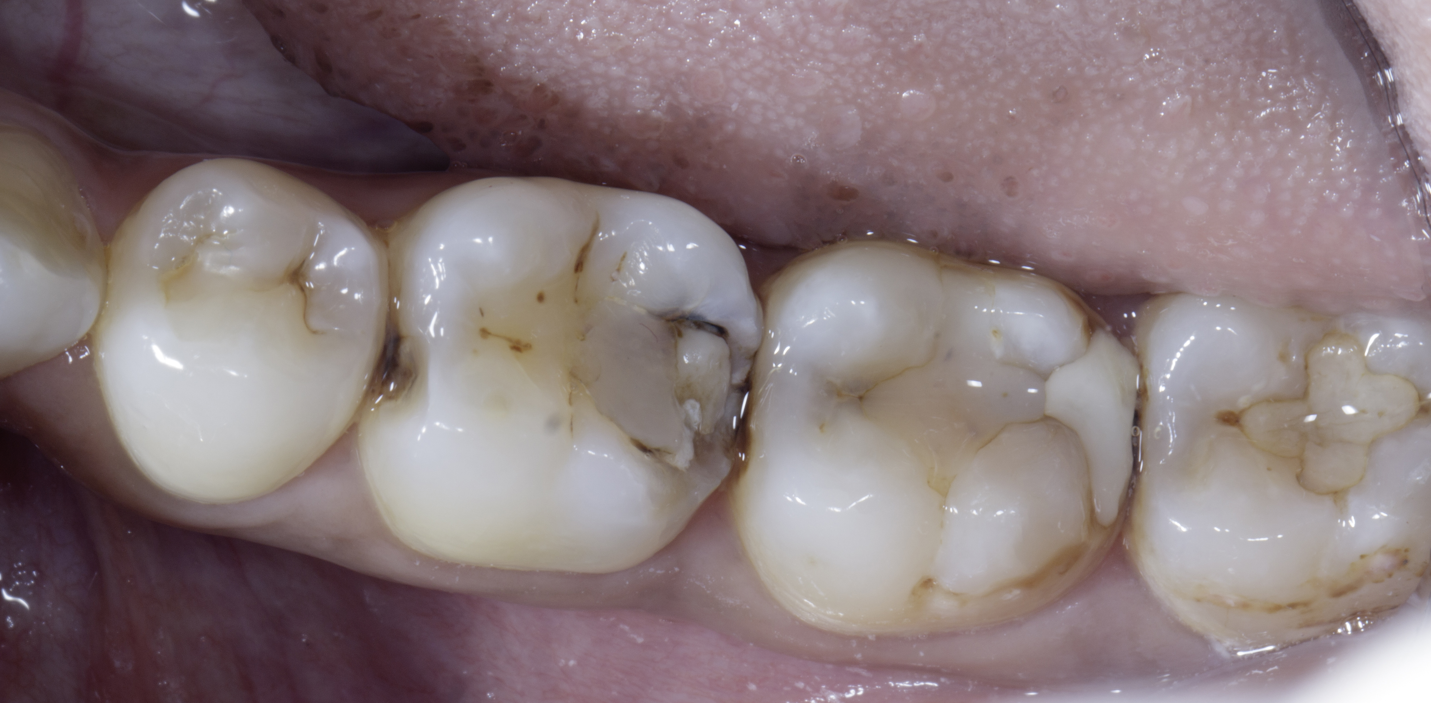 A Minimally Invasive Strategy for Restoring Complex MOD Defects with ...