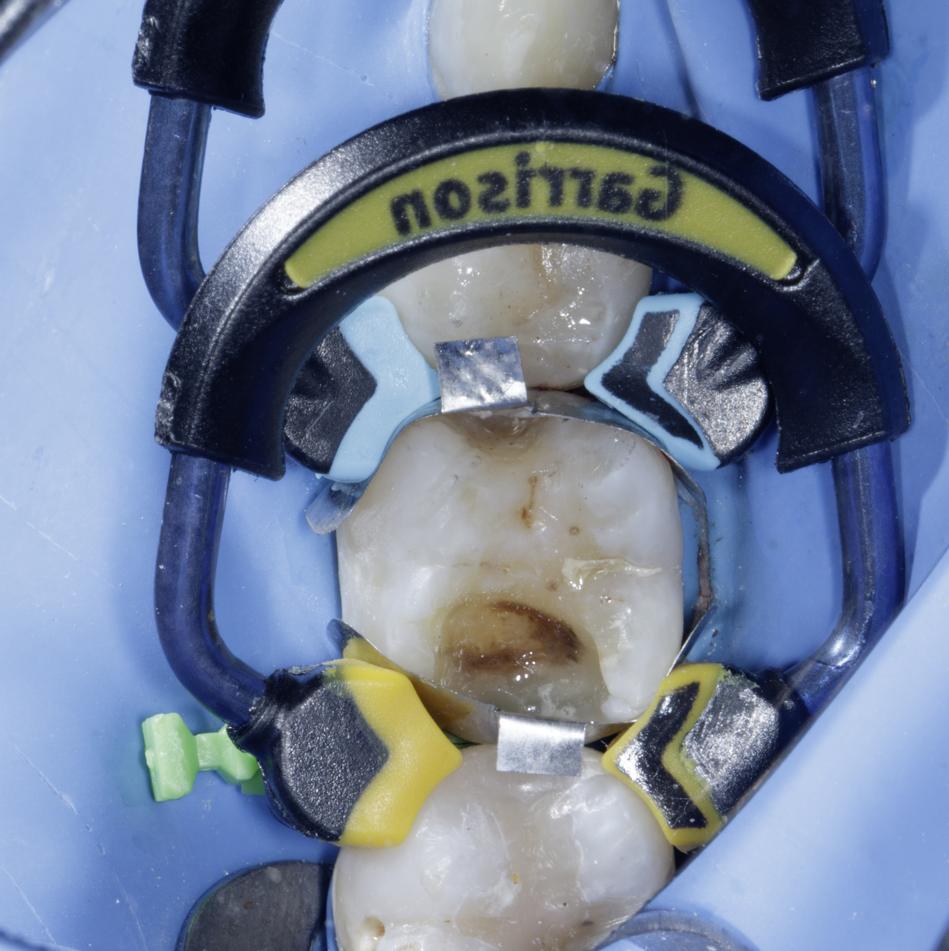 A Minimally Invasive Strategy for Restoring Complex MOD Defects with ...