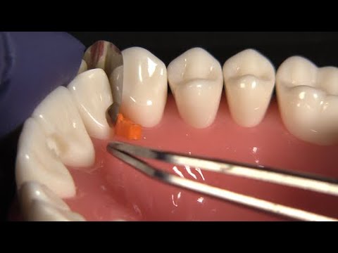 Fusion™ Anterior Matrix System