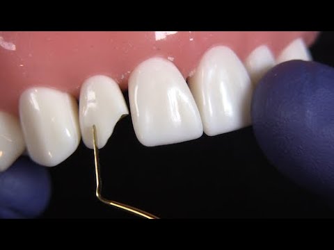 Fusion™ Anterior Matrix System