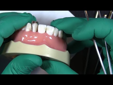 Fusion™ Anterior Matrix System