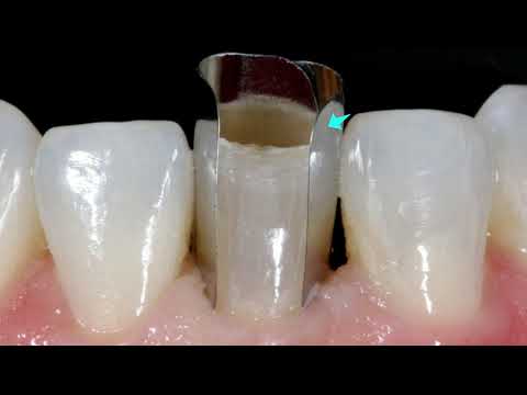 Fusion™ Anterior Matrix System