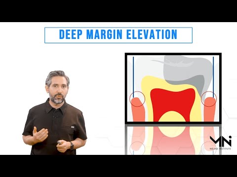 ReelMatrix™ and Deep Margin Elevation Kits