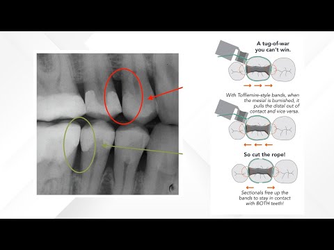 Strata-G™ Sectional Matrix System Kits