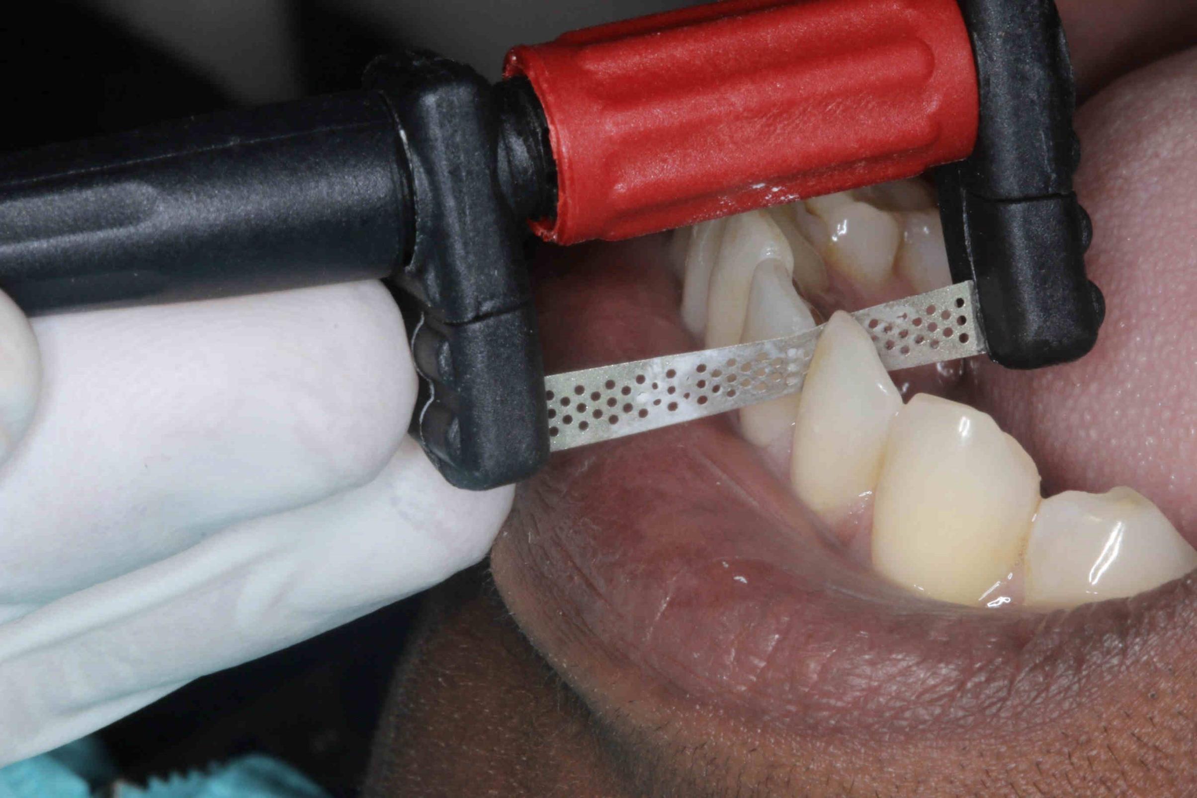 FitStrip™ Interproximal Finishing and Contouring Kits