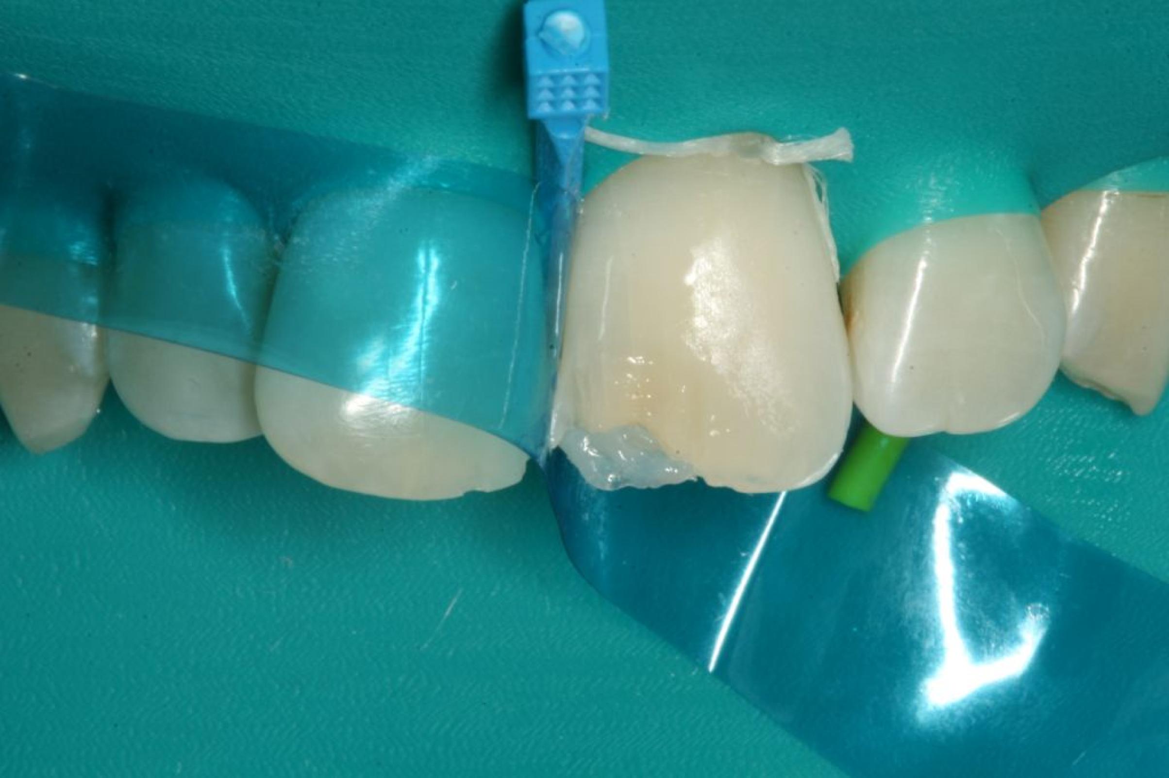 G-Wedge™ Interproximal Wedge Refills