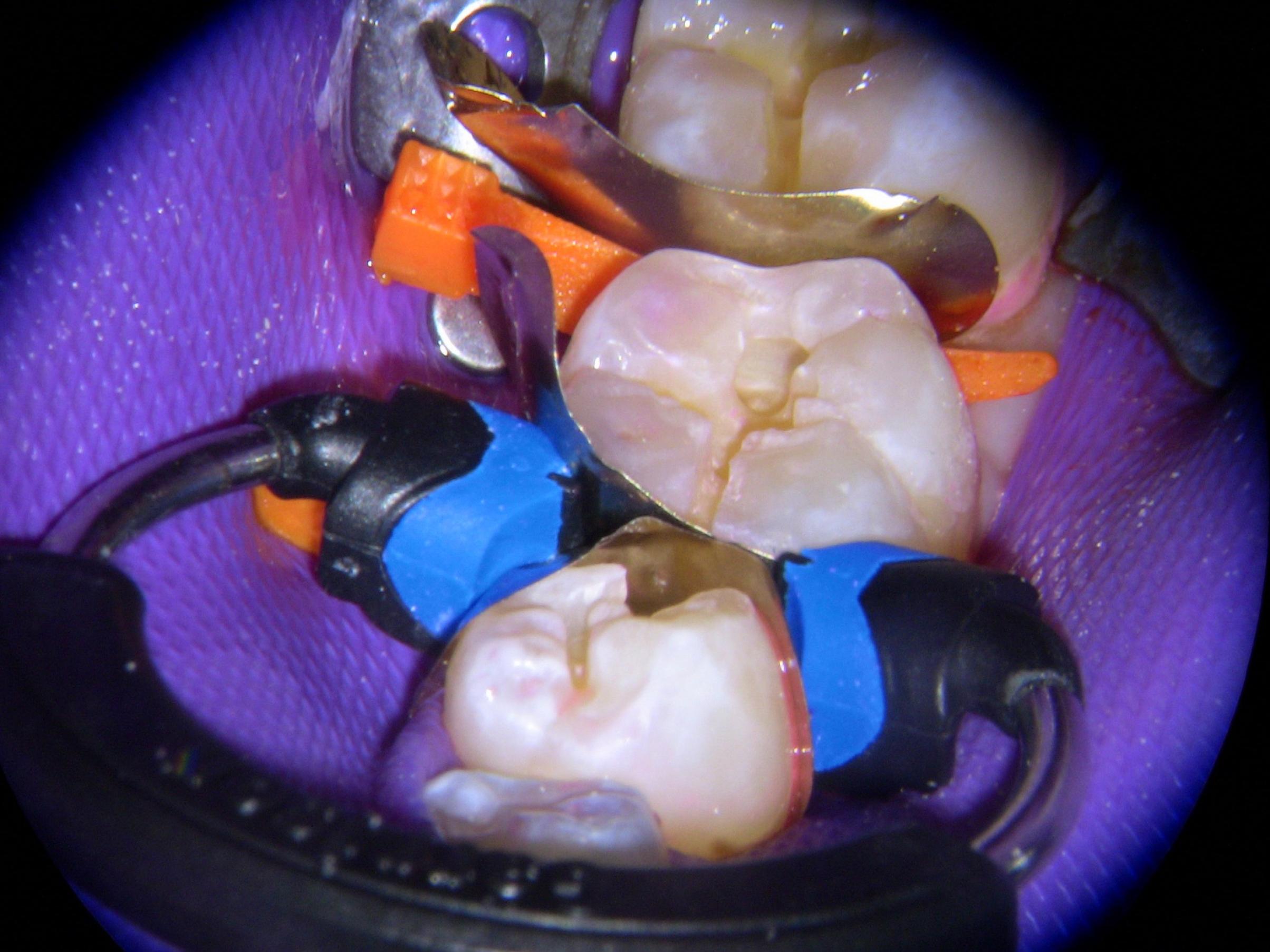 G-Wedge™ Interproximal Wedge Refills