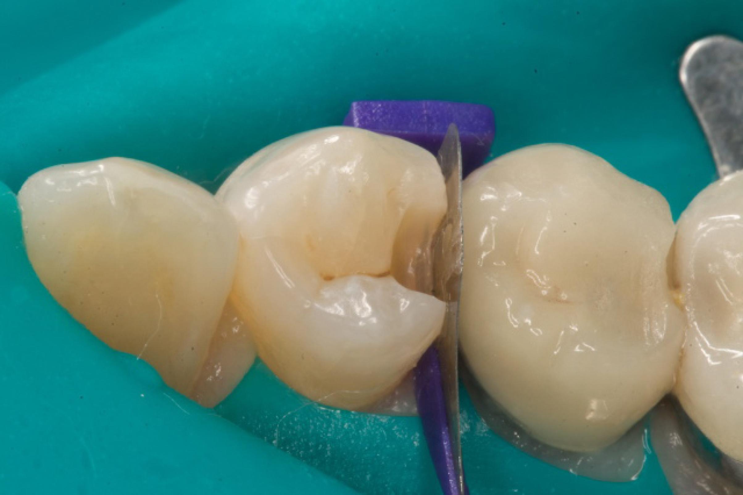 FenderWedge® Interproximal Tooth Shield Kit