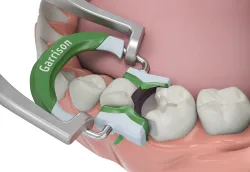 Composi-Tight® 3D Fusion™ Sectional Matrix System Kits | Garrison Dental