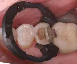 NiTin™ Sectional Matrix System | Garrison Dental