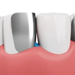 Fusion™ Anterior Interproximal Wedge Kit | Garrison Dental